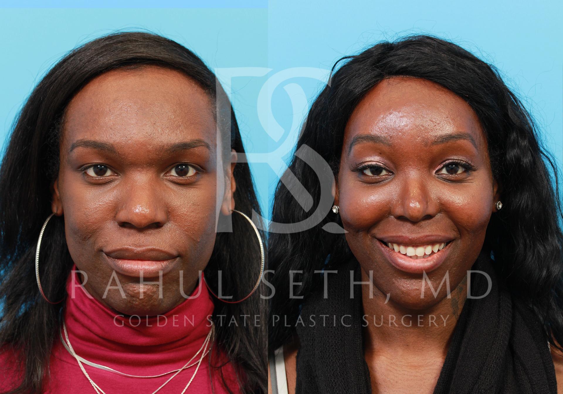 FFS San Francisco | Golden State Plastic Surgery