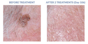 Seborrheic Keratoses | Golden State Dermatology