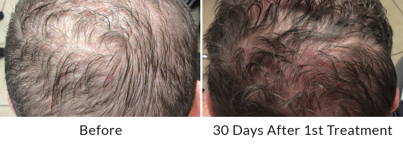 Hair Restoration | Regain Self-Esteem | Golden State Dermatology