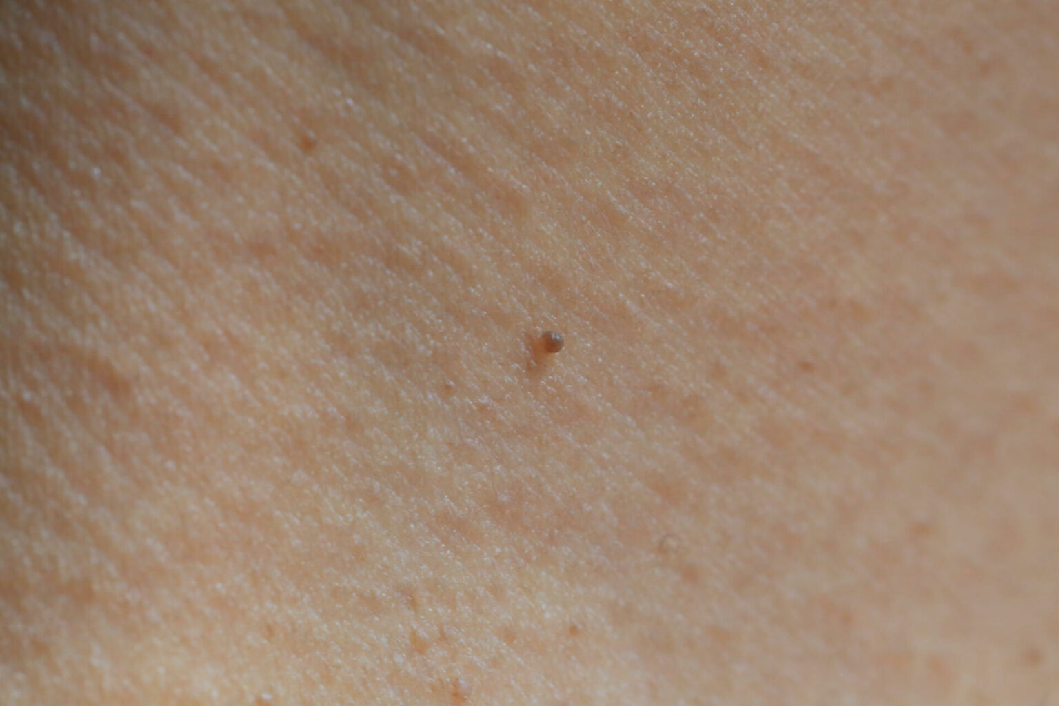 What Are Seborrheic Keratoses and How Are They Treated? - Golden State ...