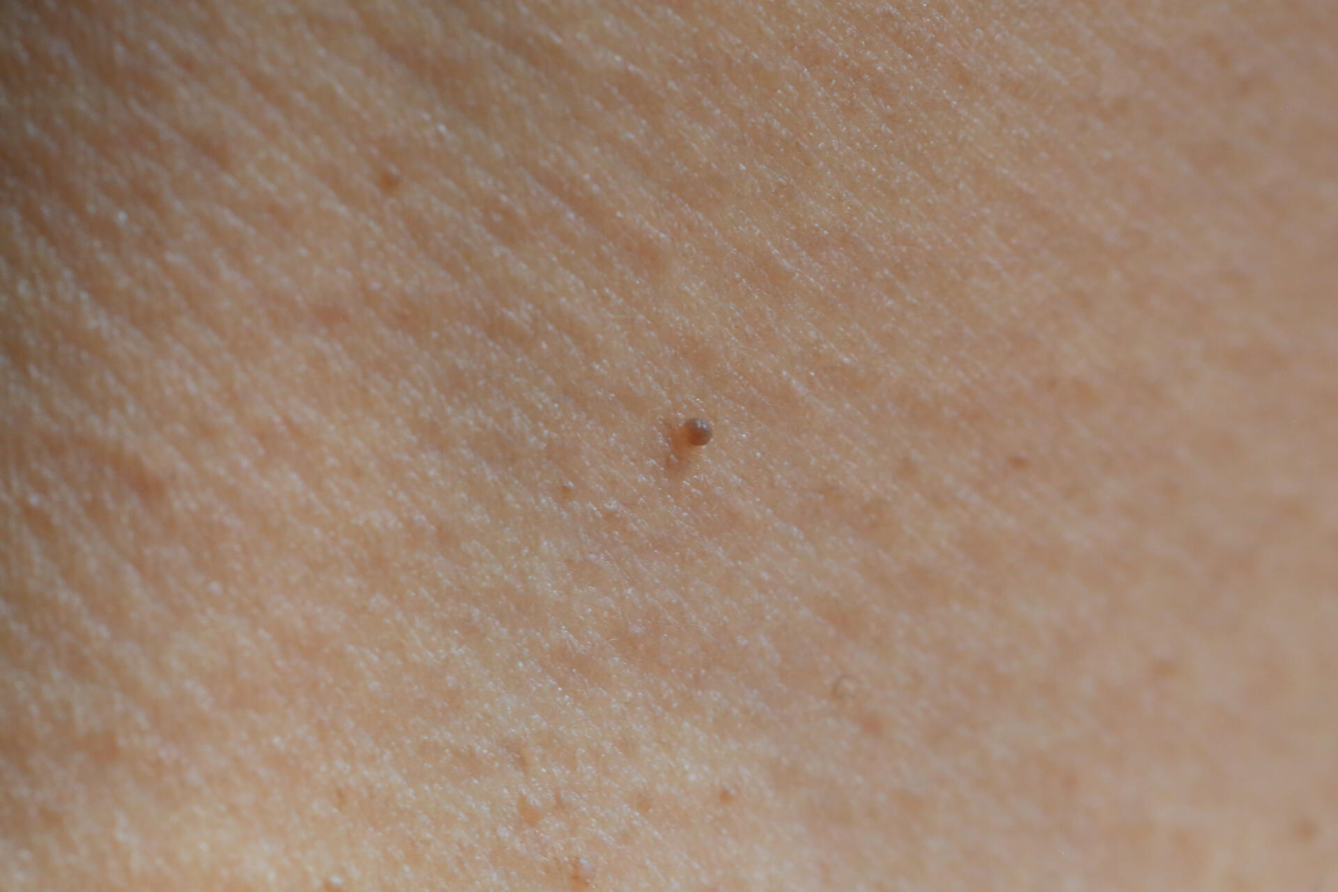 What Are Seborrheic Keratoses and How Are They Treated? - Golden State ...