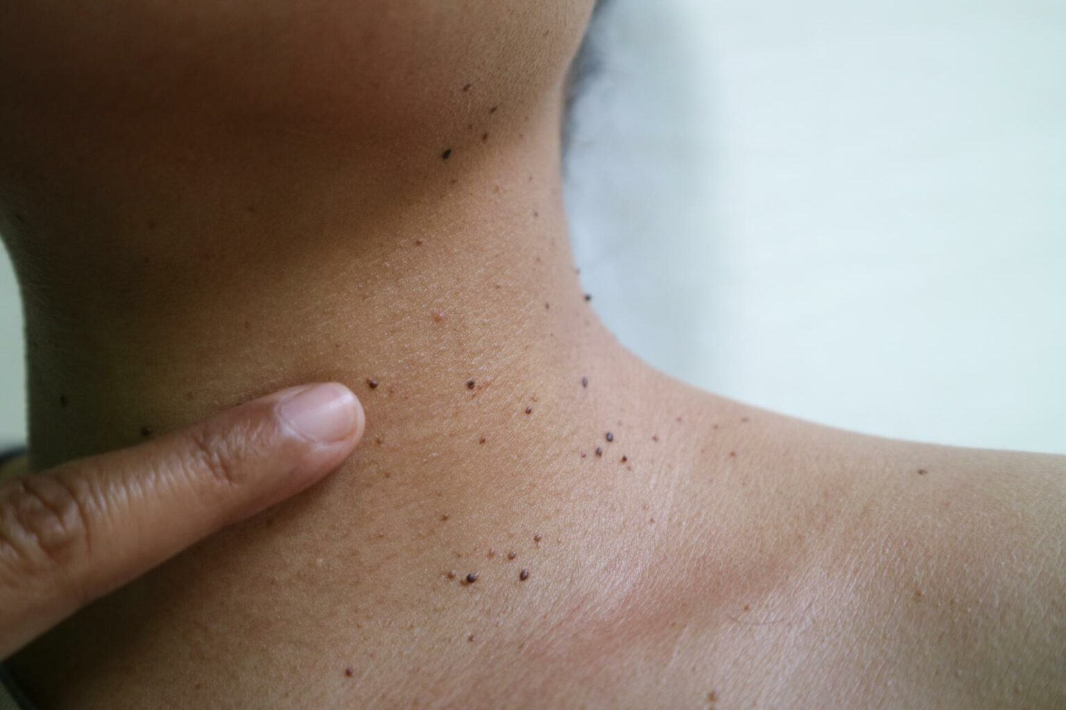What Are Seborrheic Keratoses and How Are They Treated? - Golden State ...