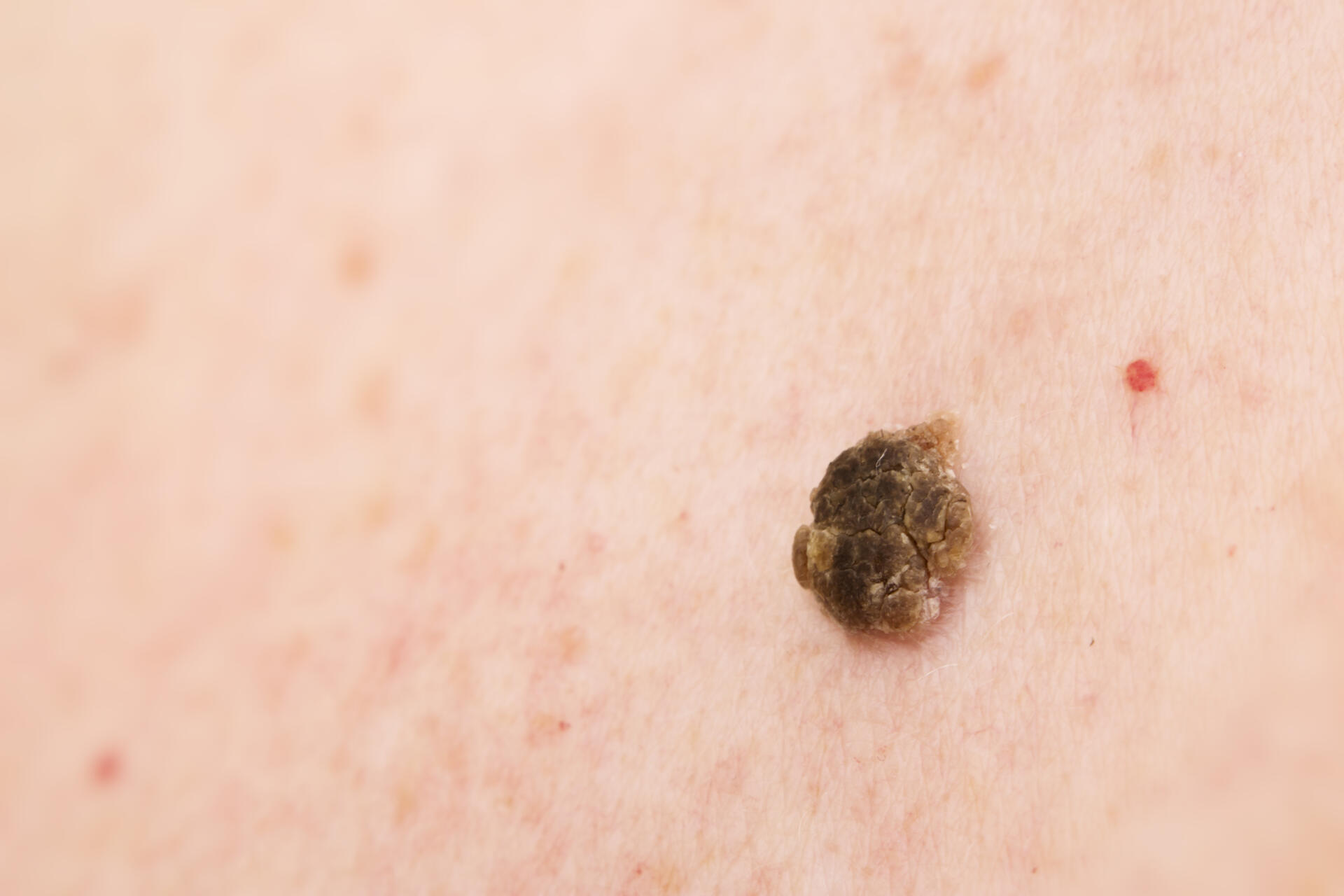 What Are Seborrheic Keratoses and How Are They Treated? - Golden State ...