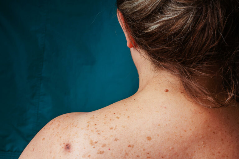 How to Get Rid of Age Bumps on the Face - Golden State Dermatology