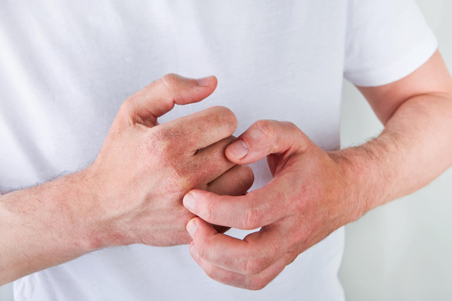 How Do You Know if You Need Systemic Medications for Psoriasis ...
